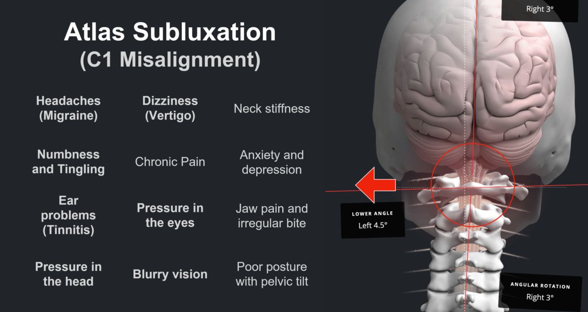 How the Atlas Misalignment Influences the Nervous System